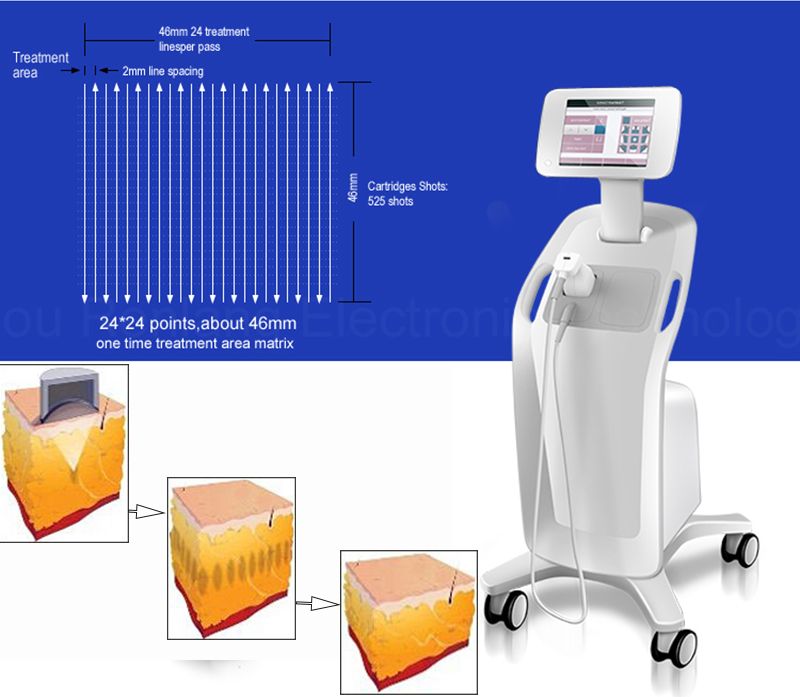 Liposonix Machine High Intensity Focused Ultrasound Liposonix Fat ...