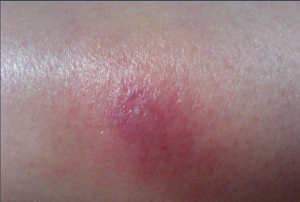 The Ultimate Guide to Finding Effective Medication for Boils