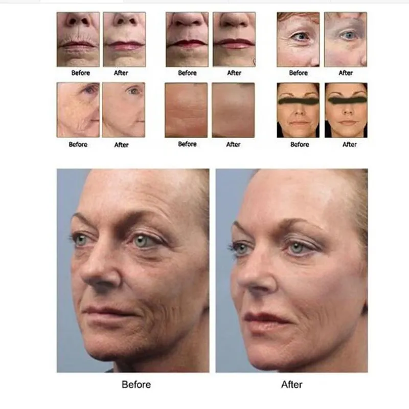 High Intensity Focused Mechanical Probe Ultrasound For Face Skin ...