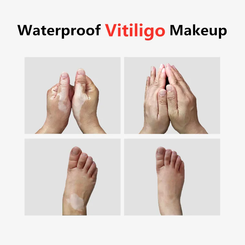 Long Lasting Waterproof Vitiligo Patches For White Skin Pen Covers ...