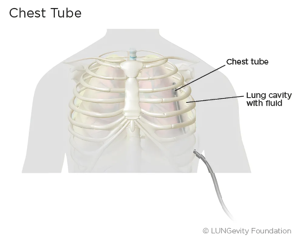 Everything You Need to Know About Chest Tubes for Fluid and Air drainage