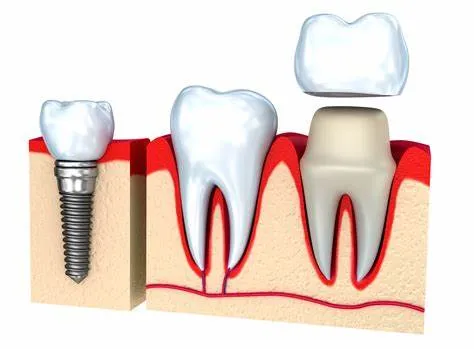 The Ultimate Guide to Choosing the Perfect Dental Cap for Your Teeth