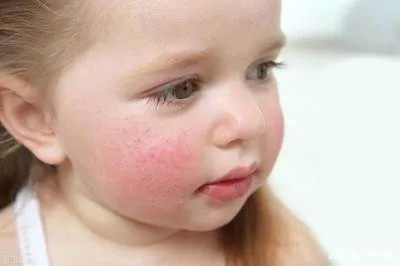 How to Treat Redness Face - The Ultimate Guide for a Flawless Complexion