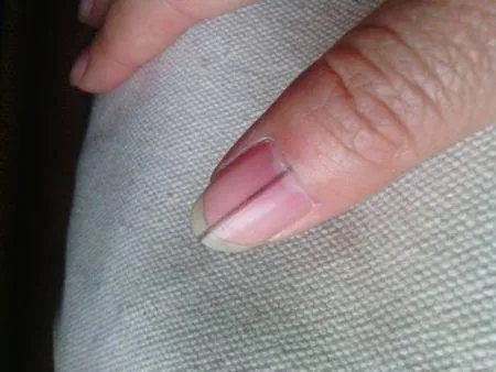 How to Identify and Treat Black Line Nail A Comprehensive Guide