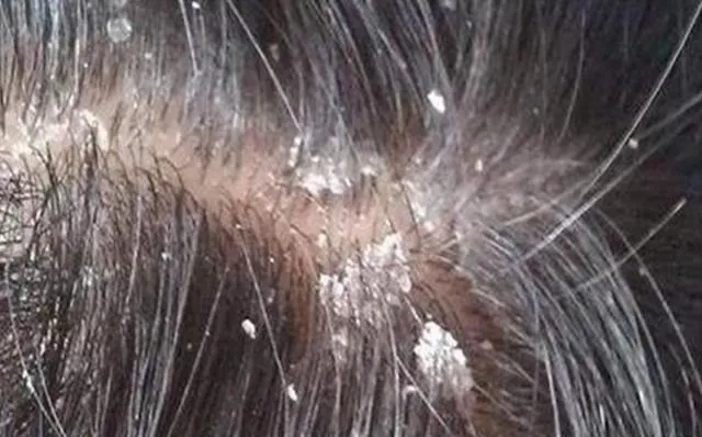 What Is The Best Shampoo Para Caspa?